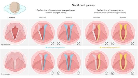 Are Vocal Cords And Vocal Folds The Same Thing At Jose Caceres Blog