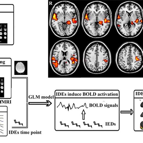 IEDs Related FMRI Brain Activation Map During Simultaneous EEG FMRI Download Scientific