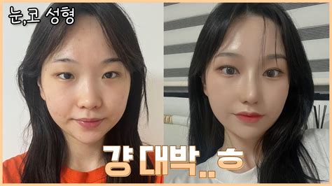눈코성형 성공케이스 성형은 이렇게 해야 제맛 자가늑 눈트임 쌍꺼풀수술 Youtube