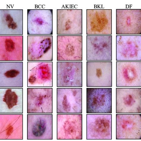 Test Predictive Performance Of The Bayesian Models In Skin Lesion Download Scientific Diagram