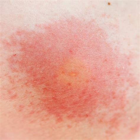 14 Common Bug Bite Pictures How To Id Insect Bites And Stings