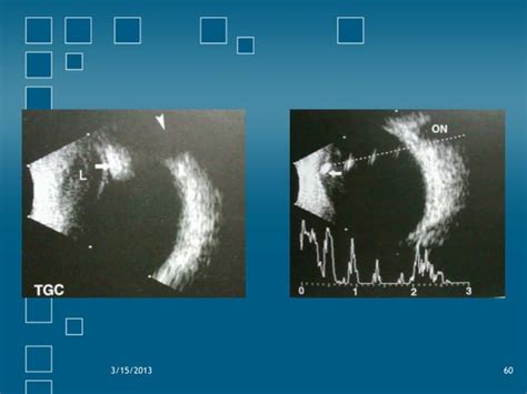 Usg B Scan Ophthalmology Pdf