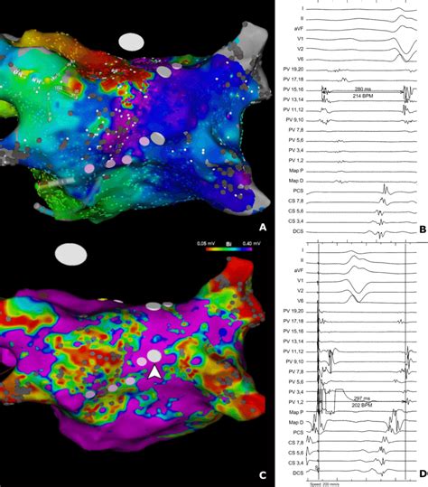 Electroanatomical Mapping Of The Left Atrium Posteroanterior View As Download Scientific