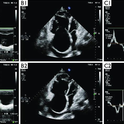 Echocardiography Results Of Cteph Patient Before Vs After Bpa Download Scientific Diagram