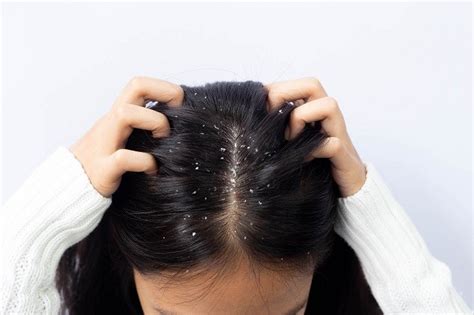 Selenium Sulfide Manfaat Dosis Dan Efek Samping Alodokter