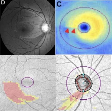 Glaucoma Oct Continued Cq Flashcards Quizlet
