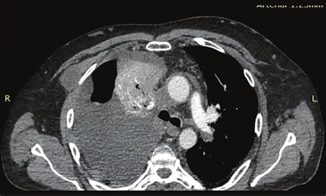 Ct Scan Showing Adenopathic Mass And Compression Of Svc Svc Superior