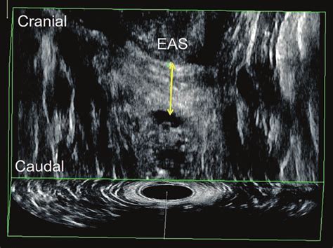2 Measurement Of The External Sphincter Eas By 3d Endoanal Download Scientific Diagram