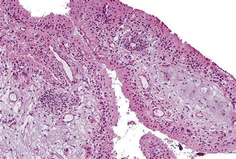 Synovial Lining Hyperplasia Pathology And Laboratory Medicine