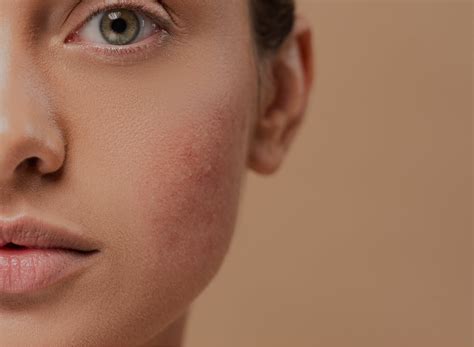 Non Cancerous Lesions Skin Benign Growth On Skin Rtwskin