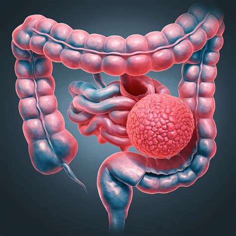 Diverticulitis And Colorectal Cancer Risk What The Research Shows