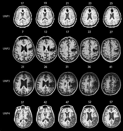 Mri Scans For All Of The Unilateral Neglect Patients Unps Included In Download Scientific