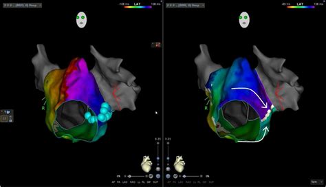 Lateral Mitral Isthmus Ablation Line Pre Ablation And Post Ablation Download Scientific Lateral Mitral Isthmus Ablation Line Pre Ablation And Post Ablation Download Scientific