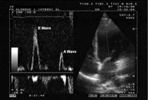 Pulsed Doppler Imaging Of Transmitral Flow Pattern Download High Quality Scientific Diagram