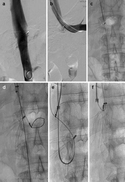 Retrieving A Tilted Ivc Filter With Struts Penetrating The Ivc Radiology Key