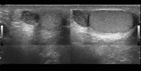 Torsion Of Appendix Testis