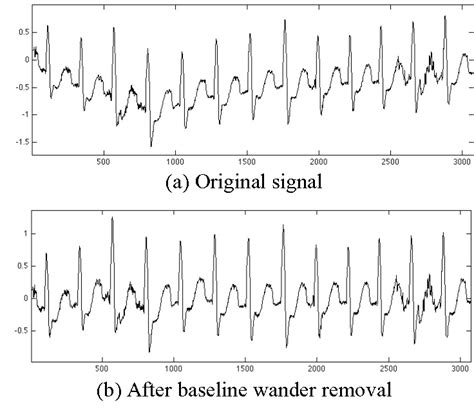 Figure 2 From Performance Analysis Of Ecg Signal Compression Using