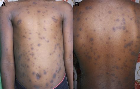 Idiopathic Eruptive Macular Pigmentation The Journal Of Pediatrics