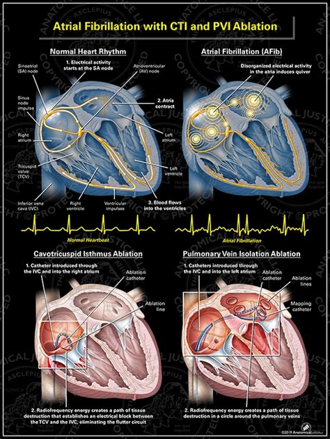 Atrial Fibrillation With Cti And Pvi Ablation