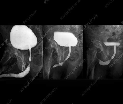 Voiding Cystourethrogram X Rays Stock Image C0180463 Science