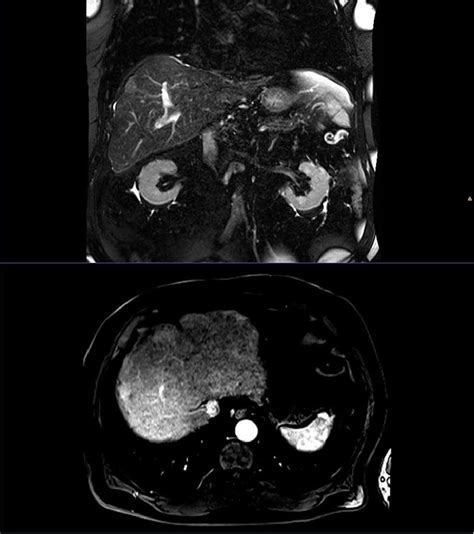 Pdf Chemoembolization As A Minimally Invasive Treatment Of Primary Malignant Liver Cancer