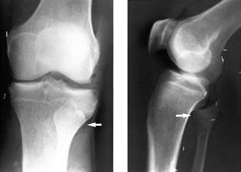 Proximal Tib Fib Dislocation Knee And Sports Orthobullets