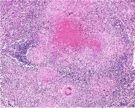 E Histopathological Picture Showing Caseating Granuloma Download