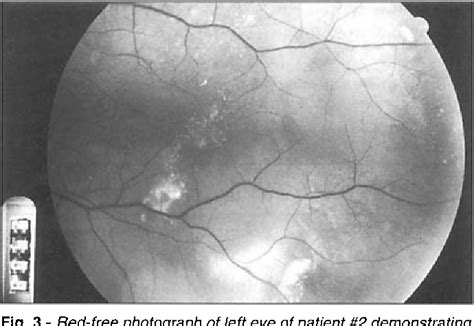 Figure 3 From Peripheral Choroidal Neovascularization Semantic Scholar
