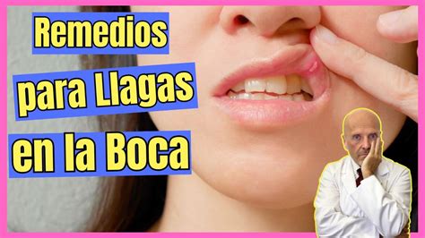 🚨 Remedios Caseros Para Llagas En La Boca Y Lengua ¿como Curar Una