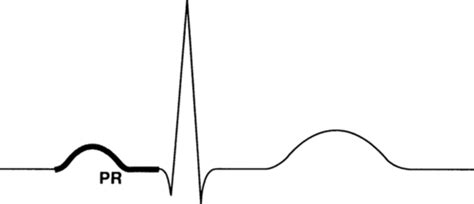 Ch 3 Waveforms Intervals Segments And Complexes Flashcards Quizlet