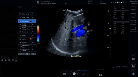 Ge Ultrasound Feature Scan Assistant Customizes And Standardizes