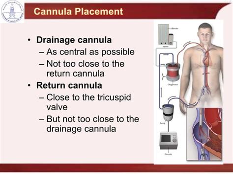 Cannulation And Recirculation In Vv Ecmo Pptx First Aid Injuries