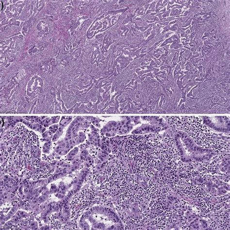 Example Of Tumor Infiltrating Lymphocytes In A Discordant Case Download Scientific Diagram