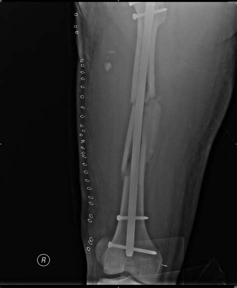 Fractured Tibia Fracture Treatment