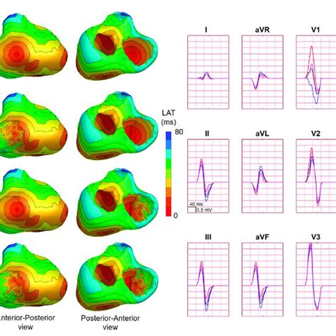 Effect Of Endocardial Vs Epicardial Disease On Body Surface Download Scientific Diagram