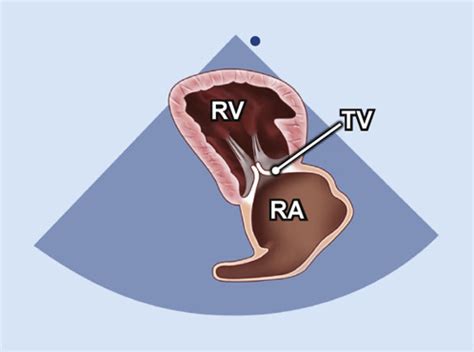 PLAX RV Inflow Echo TECHmED