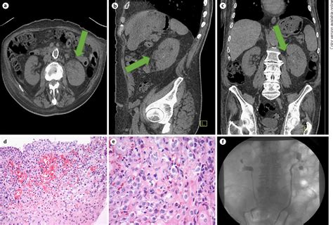 Figure 1 From Extramedullary Acute Myeloid Leukemia Of The Renal Pelvis Insights Into A