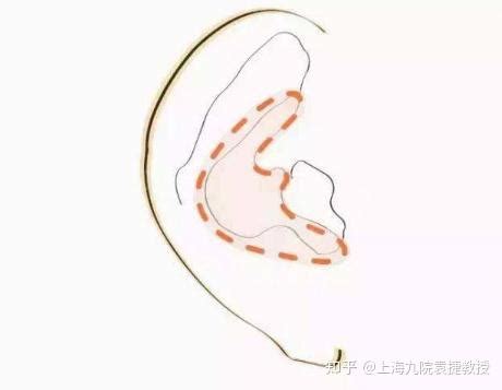 耳软骨取出后耳朵会塌吗 知乎