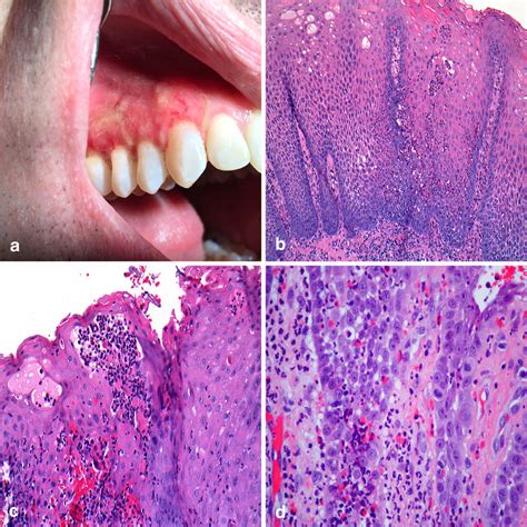 Pyostomatitis Vegetans