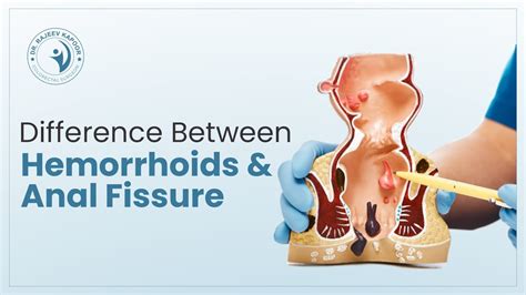 Difference Between Hemorrhoids And Anal Fissure Youtube