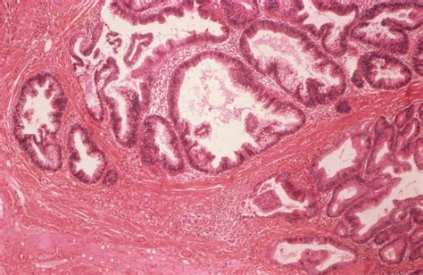 Intestinal Cancer Photograph By Cnriscience Photo Library Fine Art