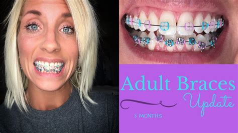 Adults With Metal Braces