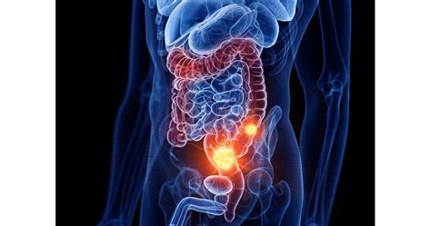 Китайски изследователи разработиха модел с ИИ за оценка на риска от рецидив на рак на дебелото