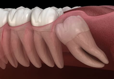 Uprighting Second Molars Kernersville Impacted Molar Bermuda Run