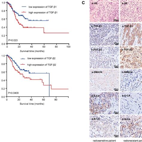 relationship between the tgf β expressions with the overall survival