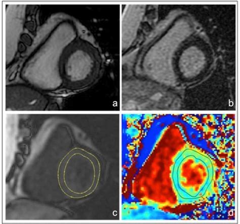 Myocardial Segmentation For Native T1 Maps Corresponding Images A Download Scientific
