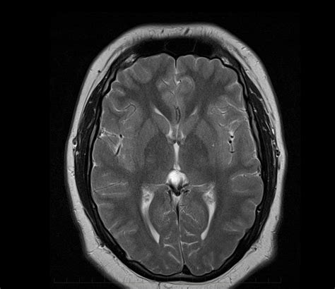 Mri Brain Arachnoid Cyst 0001 800 Mri At Melbourne Radiology Clinic