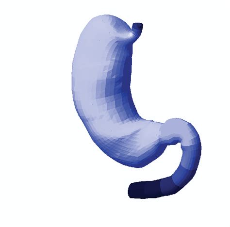 Figure 1 From Role Of Computer Analysis In Prediction Of Surgical Outcome After Billroth Ii