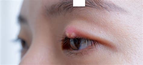 เปลือกตาอักเสบ Blepharitis อาการ สาเหตุ การตรวจวินิฉัยและการรักษา
