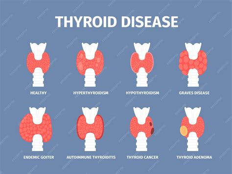Premium Vector Thyroid Gland Various Diseases Goiter And Hyperthyroid Inflammation Trachea
